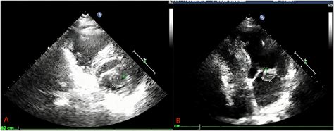 Echocardiography Shows A Cystic Mass Attached To The Posterior Leaflet