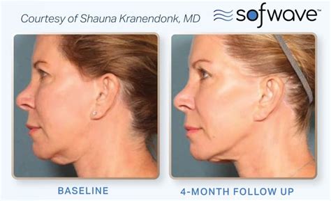 Sofwave™ Dermatology Aesthetics Of Northern Kentucky