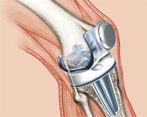 Joint Replacement Blogs Boston Orthopaedic And Spine
