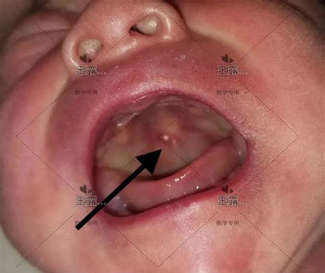 10 种不同形态的栗丘疹，你掌握了几个？粟丘疹介绍症状表现 好大夫在线