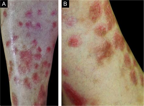 A And B Erythematous Nodules On The Extensor Surface Of The Lower Limbs Download