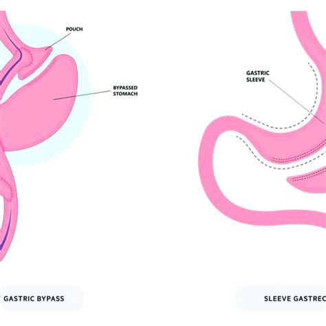Bariatric Surgery The Two Most Prominent Bariatric Procedures