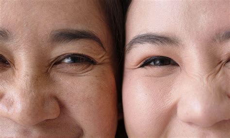 Crows Feet Wrinkles Around The Eyes Skin Social
