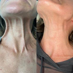 Nefertiti Necklift Platysmal Bands Décolleté Designer Aesthetics By