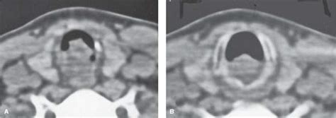 Trachea Benign And Malignant Tumors Radiology Key
