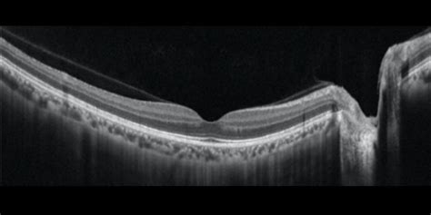 Optovue Solix Essential Oct Oct A Visionix