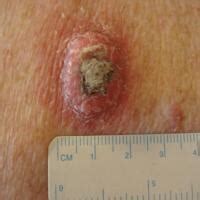 Keratoacanthoma