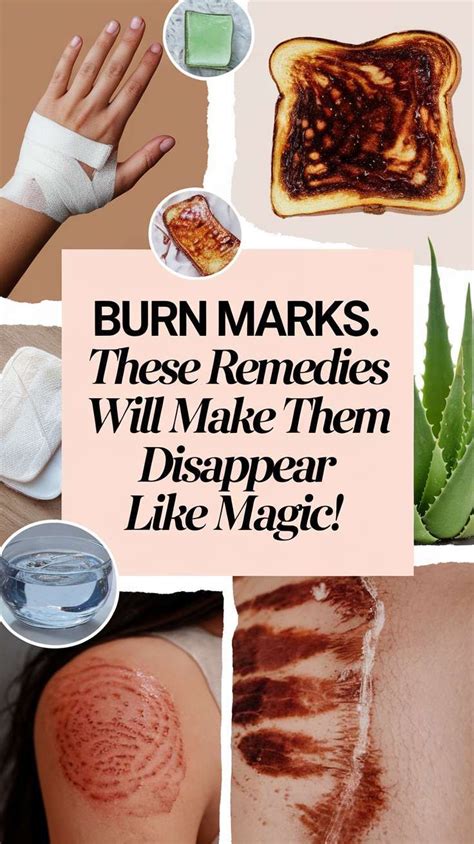 Burn Marks These Remedies Will Make Them Disappear Like Magic In 2025