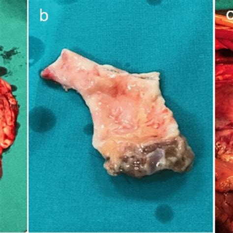 Native Pulmonary Valve Endocarditis In A 37 Year Old Patient A After