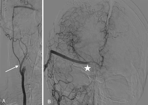 Patient 2dsa Of Secl High Flow Ec Ic Bypass After Occlusion Of The