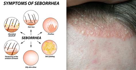 Skin Diseases Seborrheic Dermaise In An