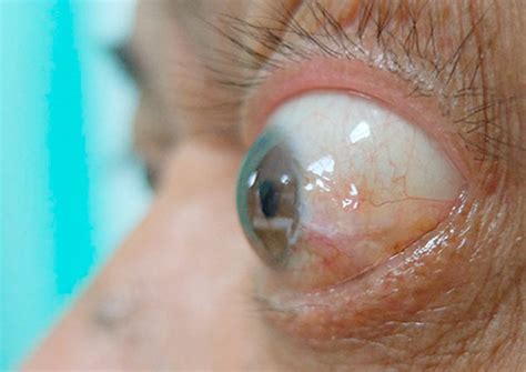 Thyroid Eye Disease Oculofacial Surgery And Cosmetic Laser Institute