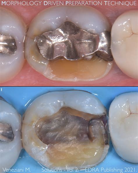 Prof Dr Markus B Blatz 🥉best Of 2024 🥉3rd Most Liked Post Clinical Steps Part 1 Of The