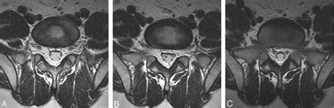 Fig 1 Reporting Terminology For Lumbar Disk Herniations Axial
