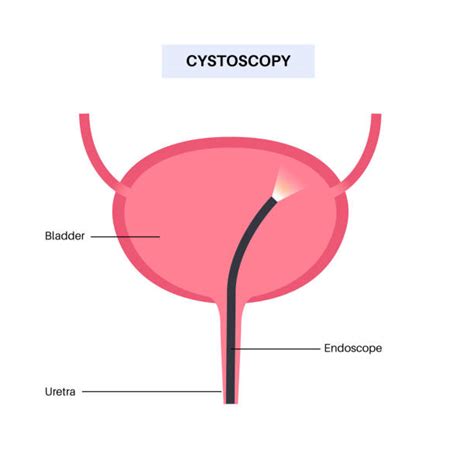 Cystoscopy Procedure