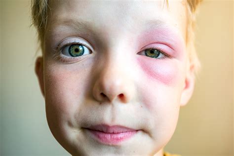 Emergency Eye Care Experts In Kelowna A B See Optometry