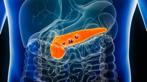 Scientists May Have Finally Found A Cure For Pancreatic Cancer