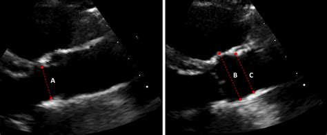 Normal Values Of Aortic Root Size According To Age Sex And Race Results Of The World Alliance