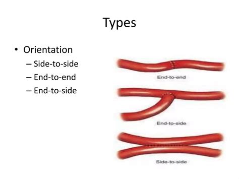 Principles Of Bowel Anastomosis Pptx