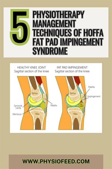 Hoffa Fat Pad Impingement Syndrome Rphysiofeed
