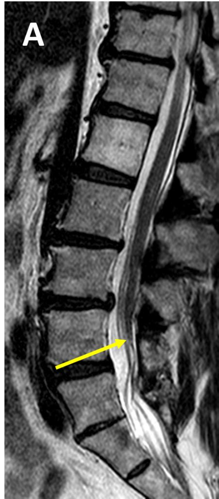 Tethered Spinal Cord Syndrome Dynamic Magnetic Resonance Imaging