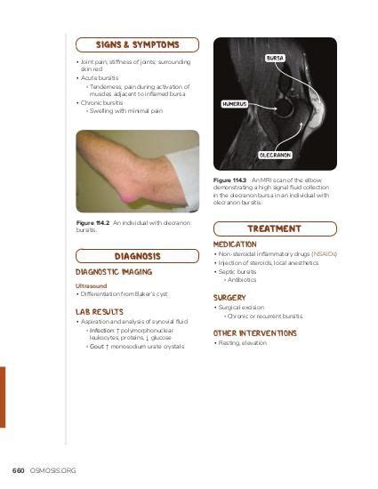 Osteoarthritis Video Causes And Meaning Osmosis