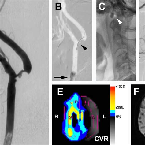 Spect Visual Rating The Output Shows A Spect Visual Inspection Of