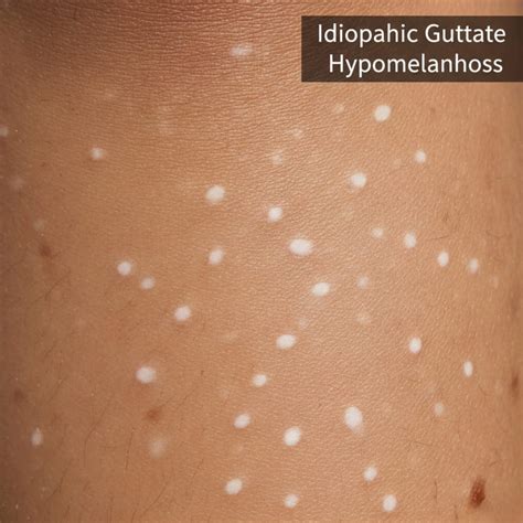 Idiopathic Guttate Hypomelanosis कारण लक्षण इलाज और रोकथाम