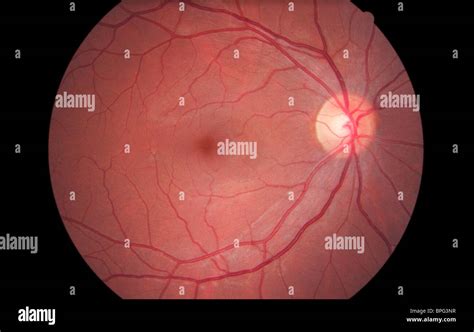 Fundus Camera Image Of The Retina Of A Normal Eye Showing The