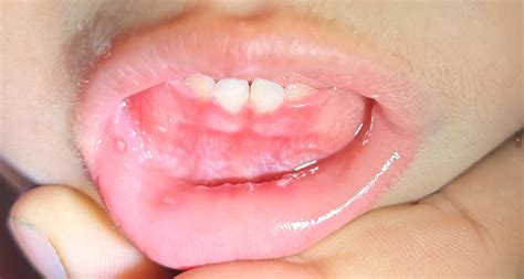 Gingivostomatitis Kater Behandlung Gingivostomatitis Katze Bilder Icialg