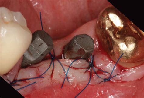 Soft Tissue Augmentation In The Region Of The Planned Implantation A Download Scientific