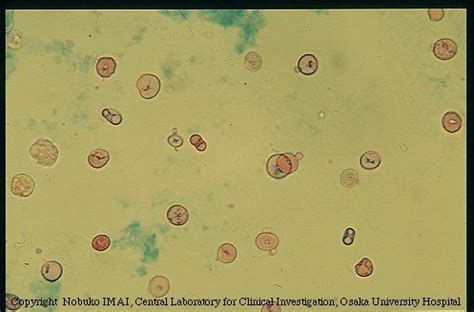 Red Cells In Urine Sediment