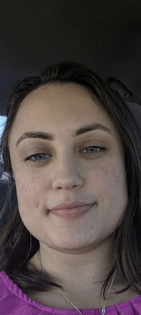 Not Great Derm Visit Rrosacea