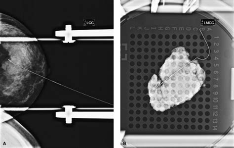 Needle Localization Biopsy Of Nonpalpable Breast Lesions Plastic