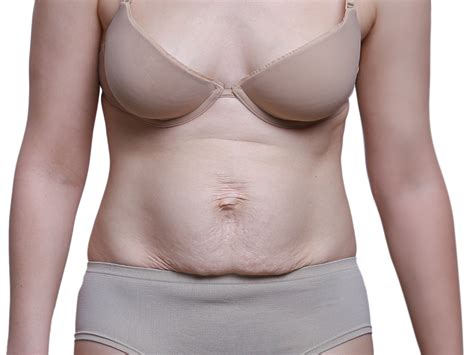 Rectus Abdominis Diastasis Diastasis Recti What Is It And What To Do