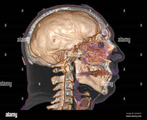 Normal Head 3d Ct Scan Side View 3d Model Of A Persons Head Using X
