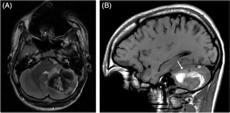 Cerebral Cavernous Malformations Typical And Atypical Imaging
