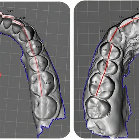Measuring The Tooth Width On The Digital Model Obtained From The Ios A