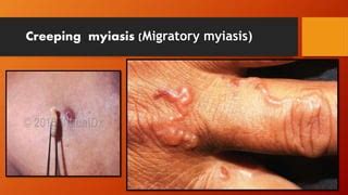 Myiasis A Parasitic Disease Pptx