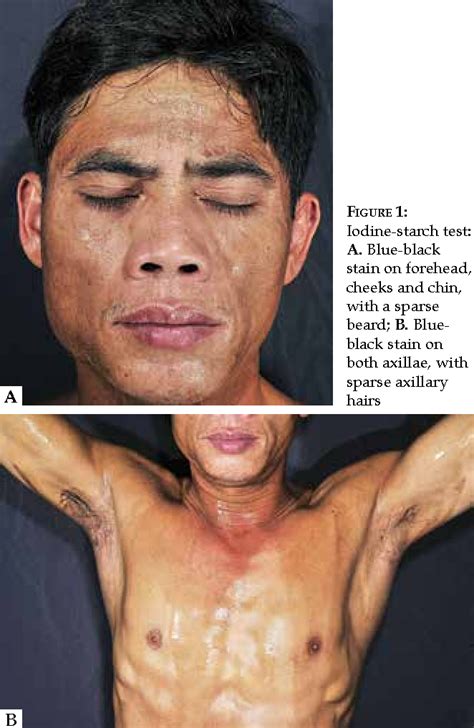 Figure 1 From First Case Of Congenital Idiopathic Hypohidrosis In China Semantic Scholar
