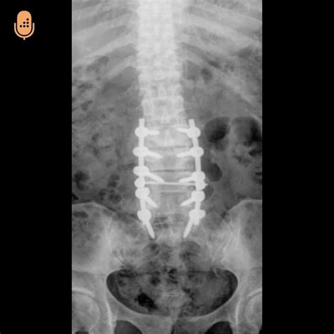 Orthobullets Sacroiliac Joint Dysfunction Is A