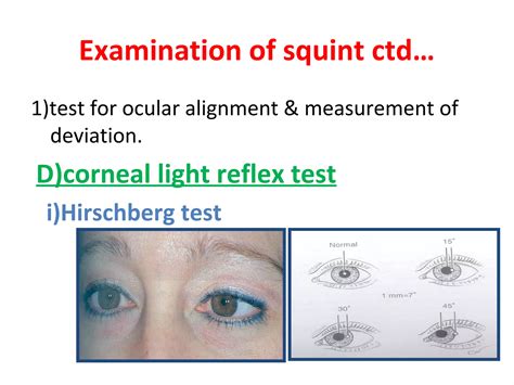 Strabismus By Raju Ppt Eye And Vision Conditions Diseases And Conditions
