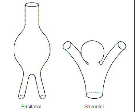 Classification Of Aneurysms Based On Shape 9 Fusiform Aneurysms The