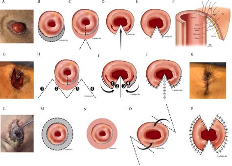 Stomal Stenosis After Continent Urinary Diversion In Bladder Exstrophy