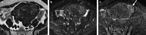 Sex Cord Stromal Tumors Radiology Key