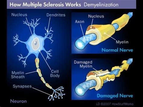 Multiple Sclerosis Louis Hofmeyr