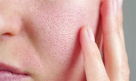 Contact Dermatitis Face