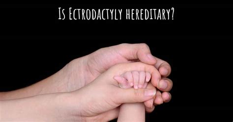 Is Ectrodactyly Hereditary
