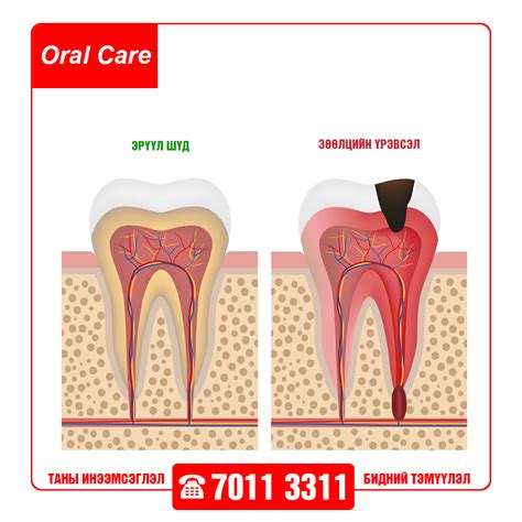 Шүд цоорох өвчний хүндрэл шүдний зөөлөн эдийн үрэвсэл пульпит гэж юу вэ