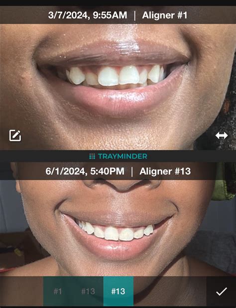 13 Weeks Of Progress Rinvisalign